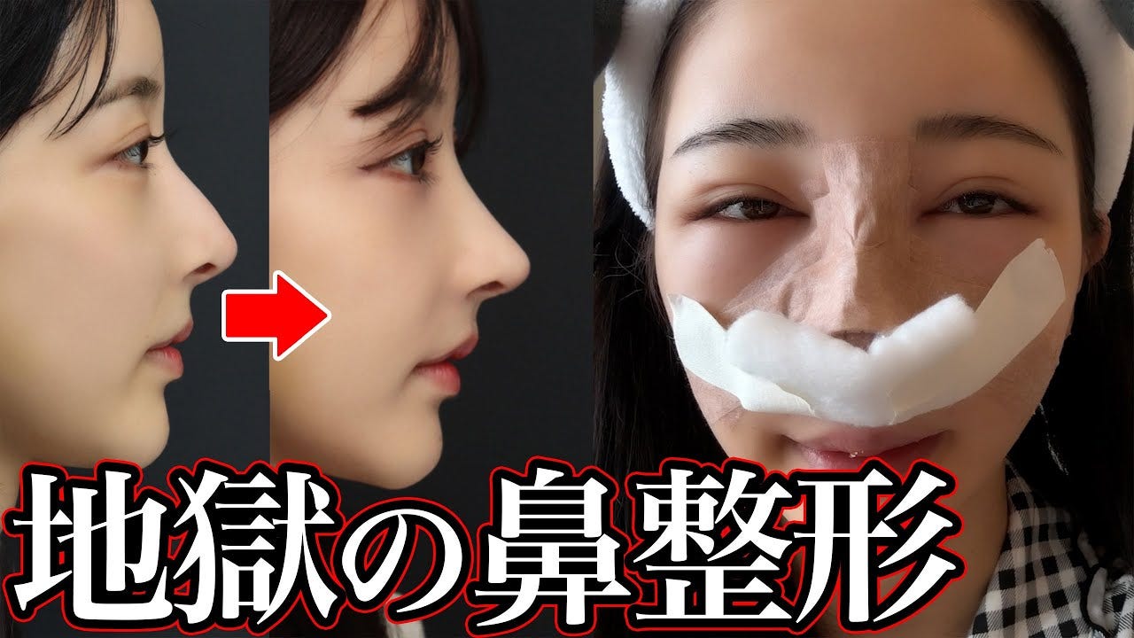 画像6 10 美人youtuber・rちゃん、鼻整形ビフォーアフター公開 壮絶ダウンタイム姿も モデルプレス